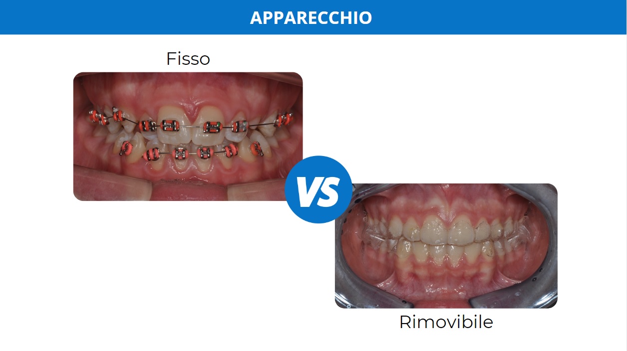 Apparecchio fisso o rimovibile: patti chiari per una scelta consapevole ...